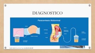 Presentacion clinica del ascitis en pacientes.pptx