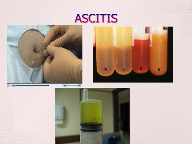 Ascitis
