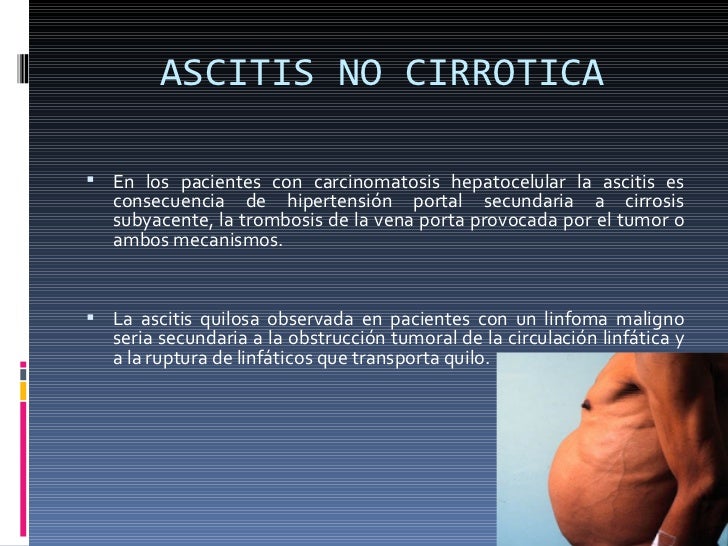 Ascitis y paracentesis