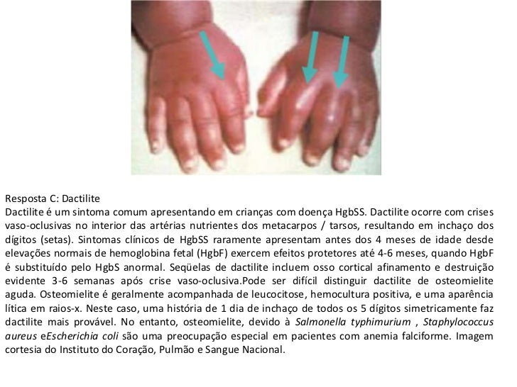 As complicações graves da doença falciforme slideshow