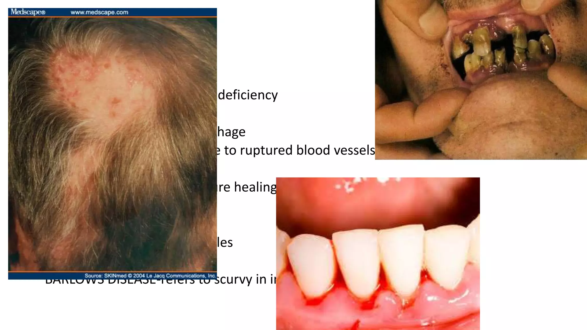 Ascorbic acid | PPTX