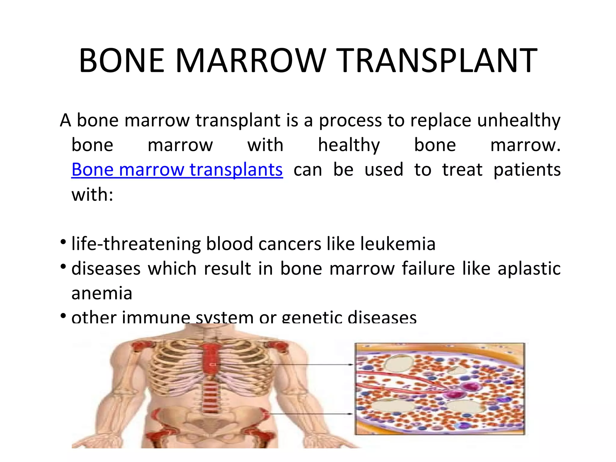 autologous bone marrow transplant | PPT