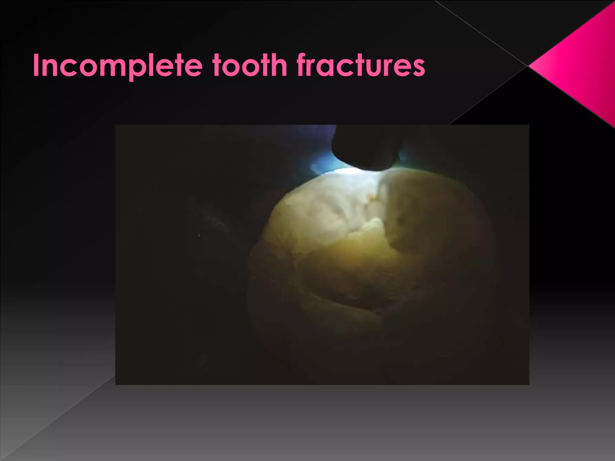 Fiber-OpticTransillumination In dentistry | PPTX
