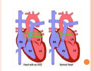 ATRIAL SEPTAL DEFECT ( ASD) | PPTX