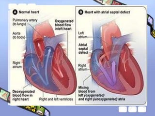 ASD (ATRIAL SEPTAL DEFEK) keperawatan PP.pptx
