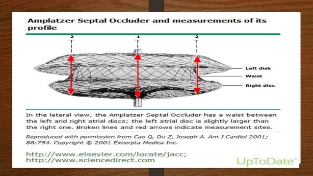 Asd device closure | PPTX