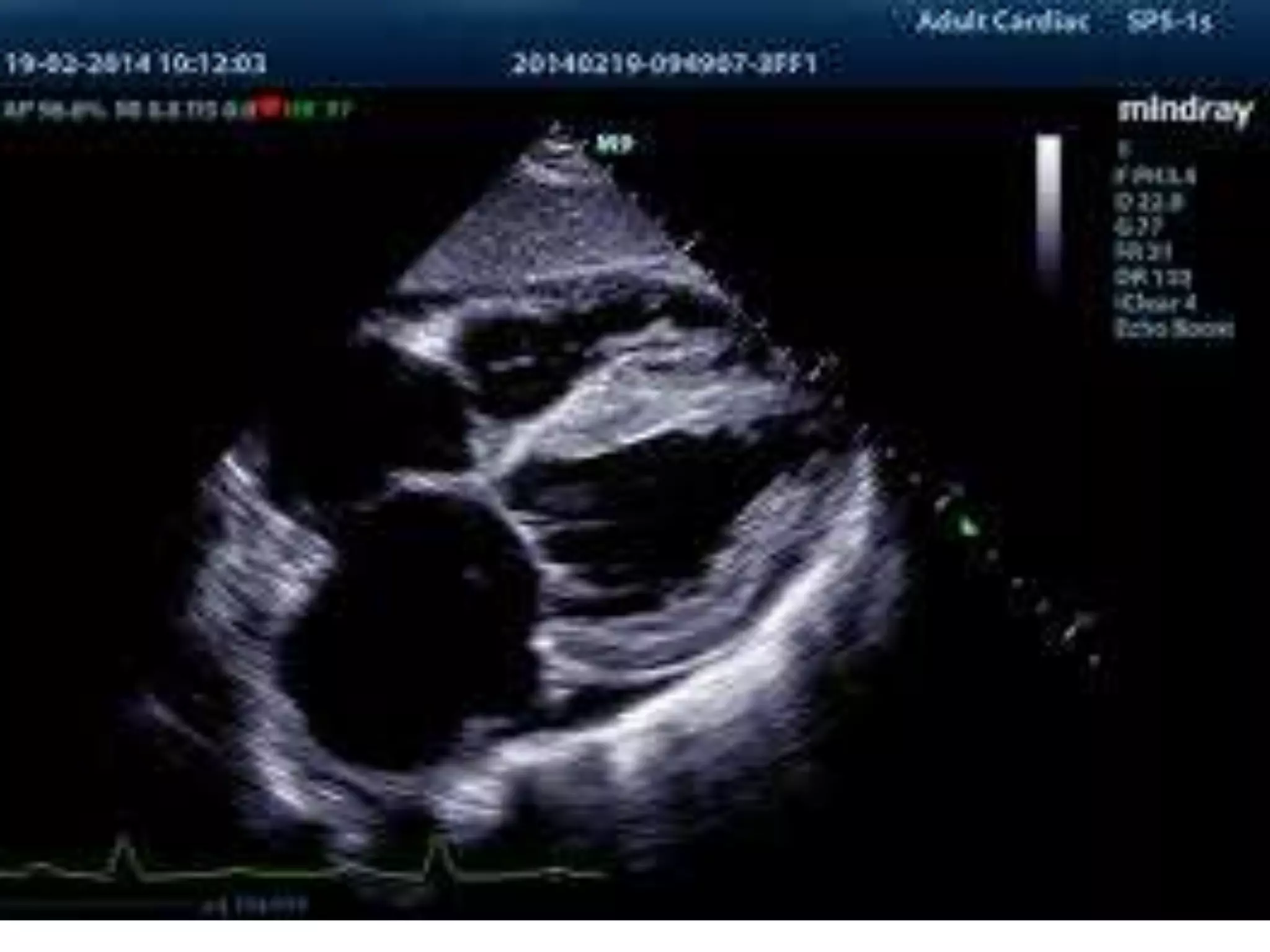 Asd echo assessment | PPTX