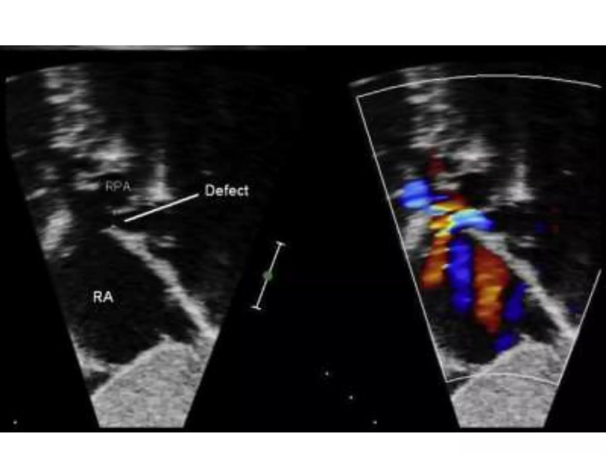 Asd echo assessment | PPTX