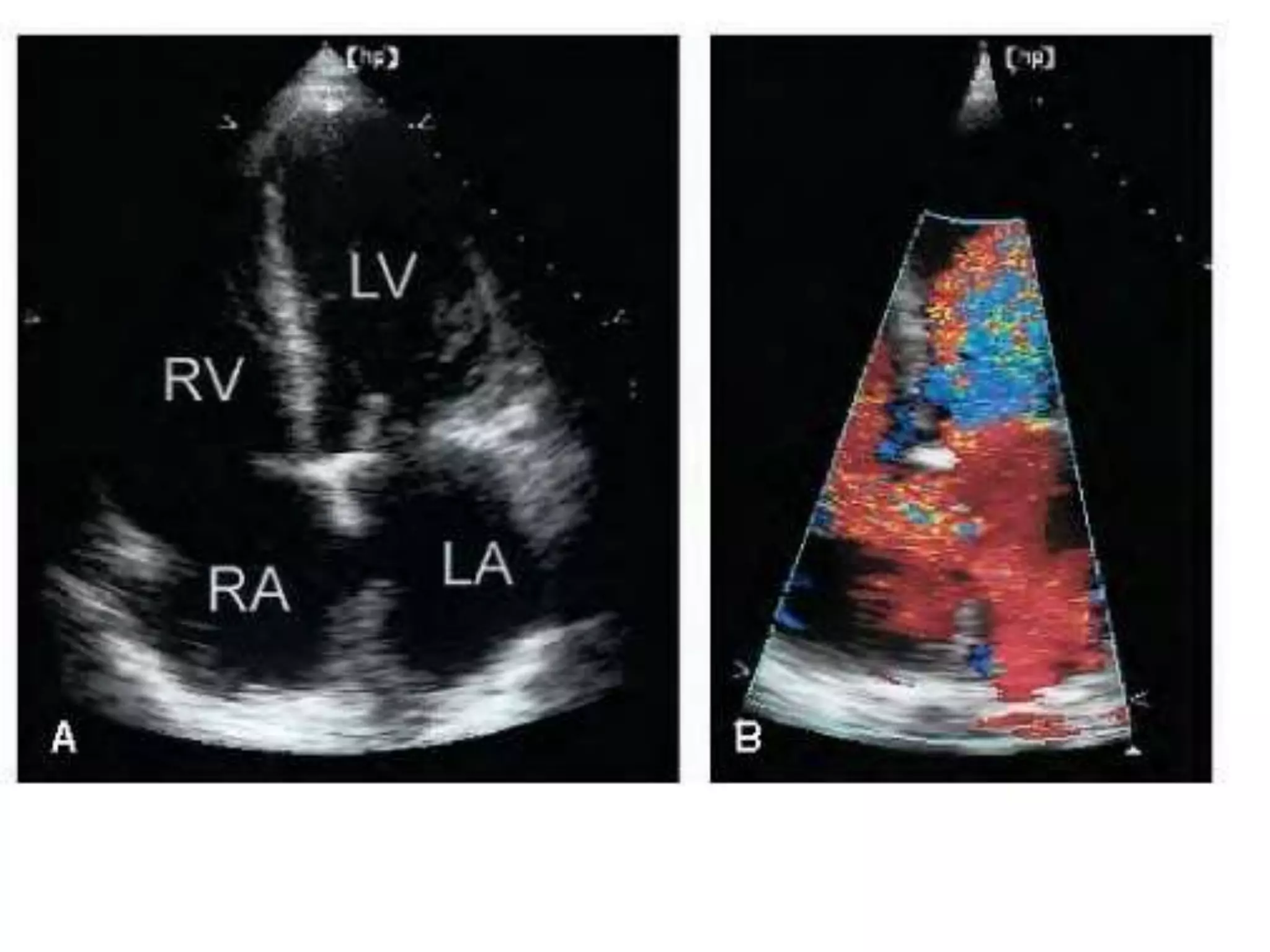 Asd echo assessment | PPTX