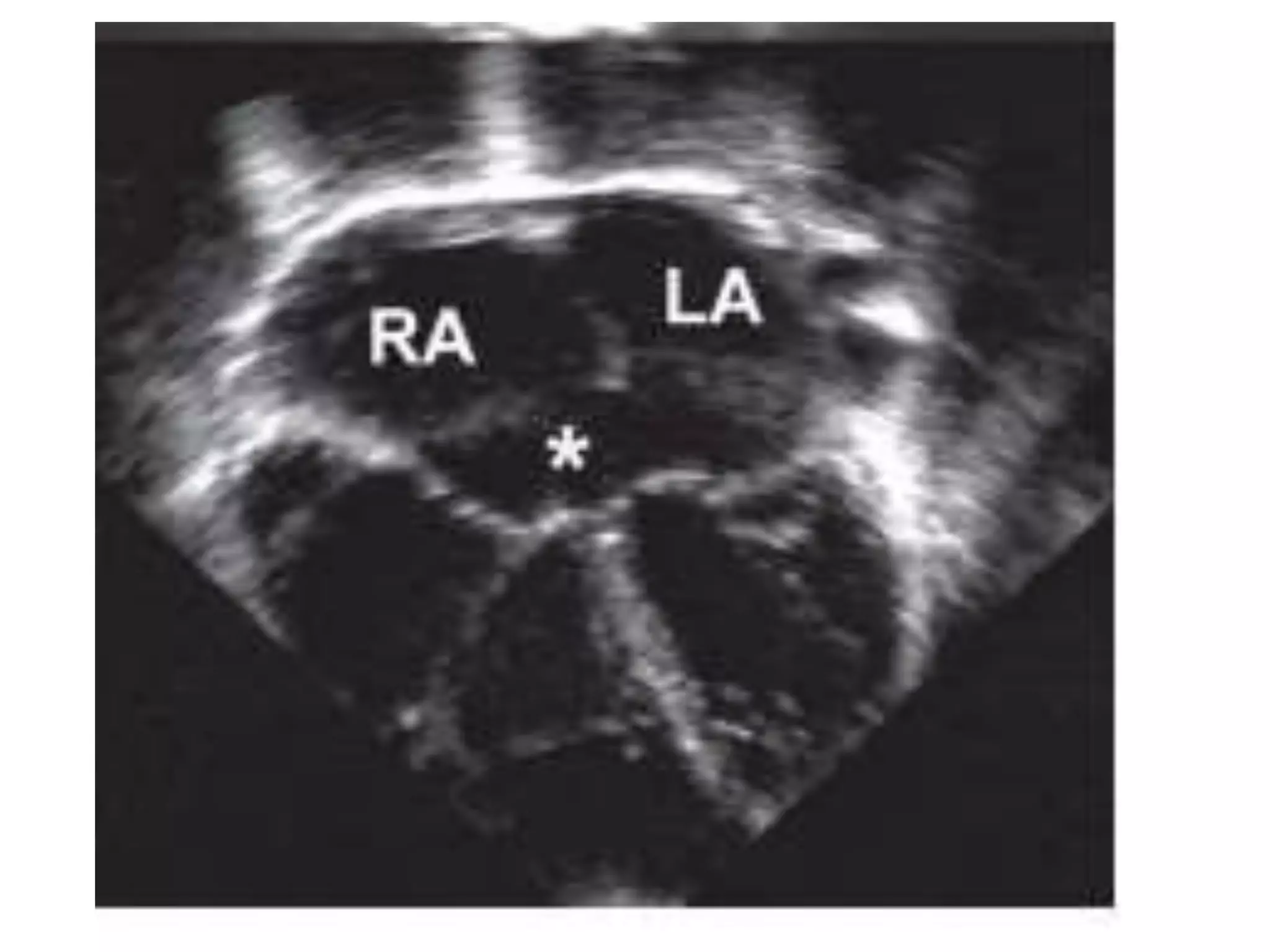 Asd echo assessment | PPTX