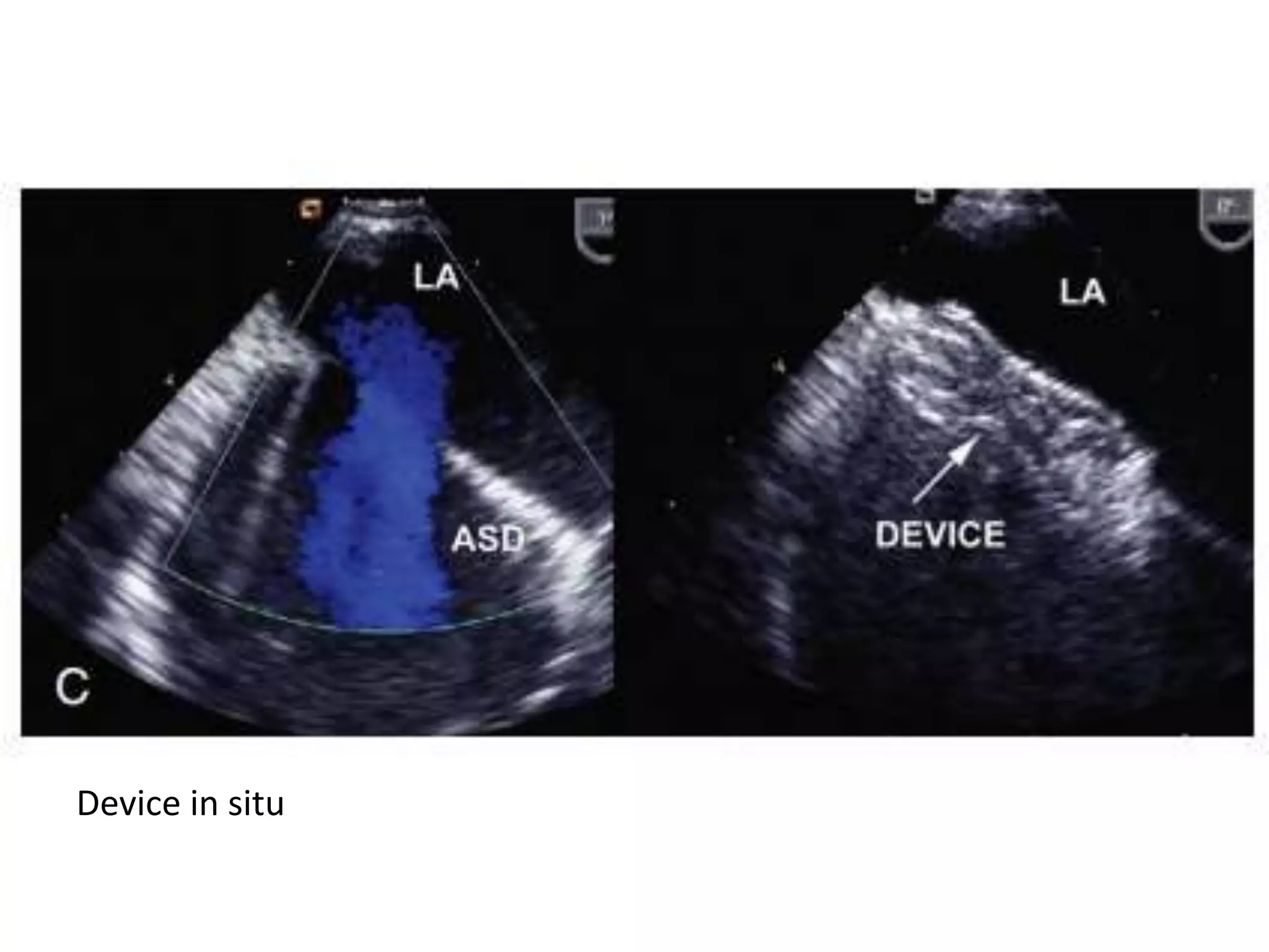 Asd echo assessment | PPTX