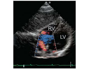 Asd echo assessment | PPTX