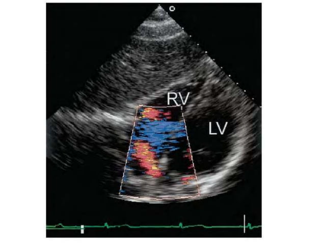 Asd Echo Assessment Pptx