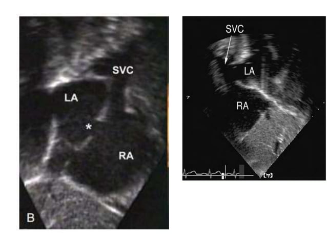 Asd echo assessment | PPTX