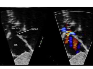 Asd echo assessment | PPTX
