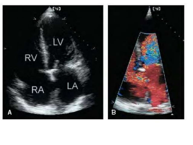 Asd echo assessment | PPTX