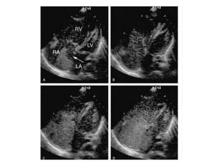 Asd echo assessment | PPTX
