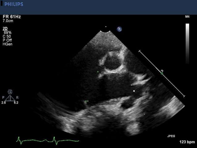 Asd echo assessment | PPTX