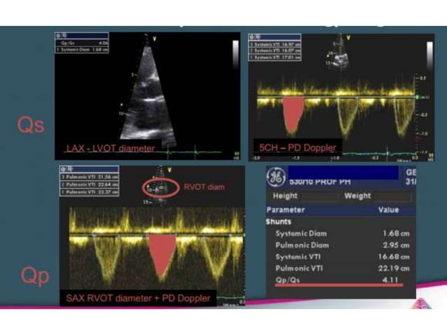 Asd echo assessment | PPTX