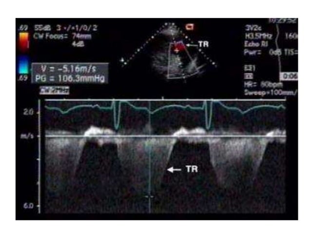 Asd echo assessment | PPTX