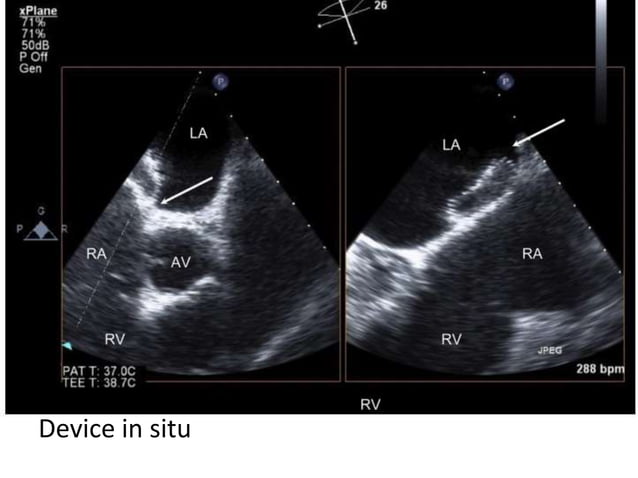 Asd echo assessment | PPTX