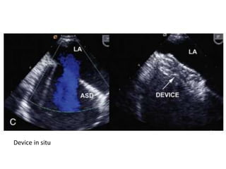 Asd echo assessment | PPTX