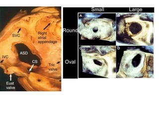 Asd echo assessment | PPTX