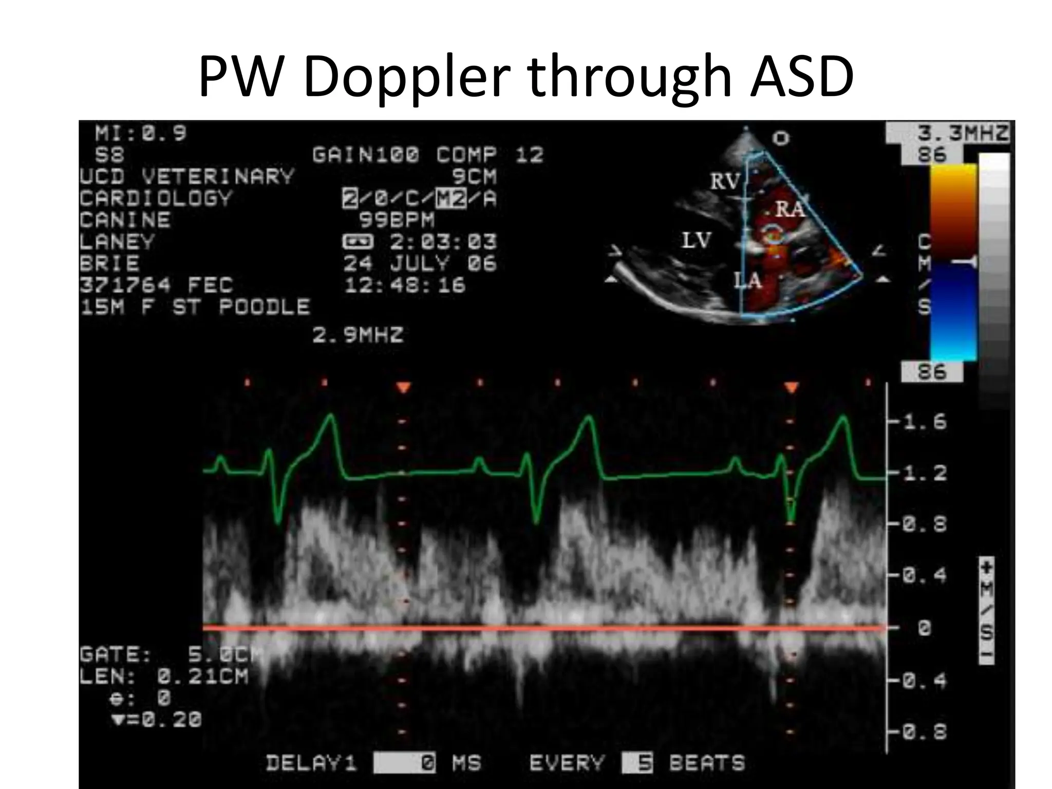 ASD ECHO ASSESSMENT renewed slideshow.pptx | Heart and Cardiovascular ...