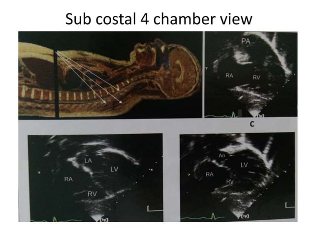 ASD ECHO ASSESSMENT renewed slideshow.pptx | Heart and Cardiovascular ...