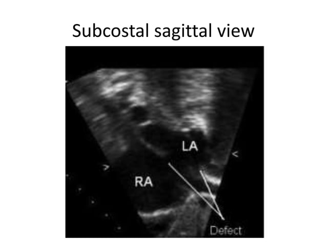 ASD ECHO ASSESSMENT renewed slideshow.pptx | Heart and Cardiovascular ...