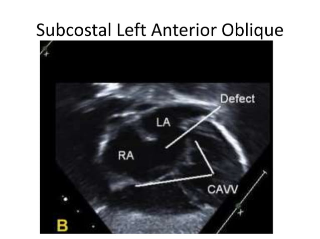 ASD ECHO ASSESSMENT renewed slideshow.pptx | Heart and Cardiovascular ...