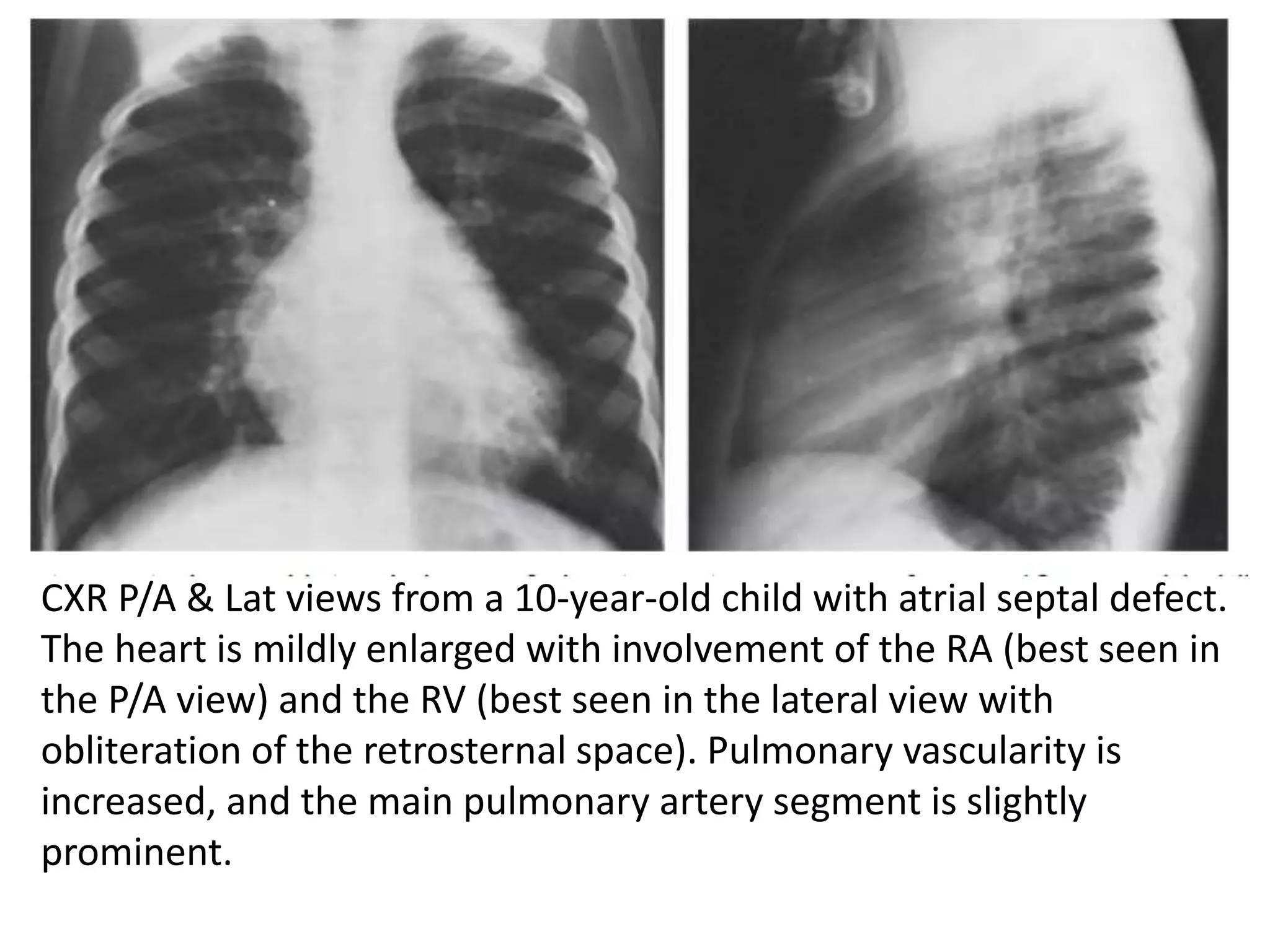 Atrial Septal Defect | PPTX