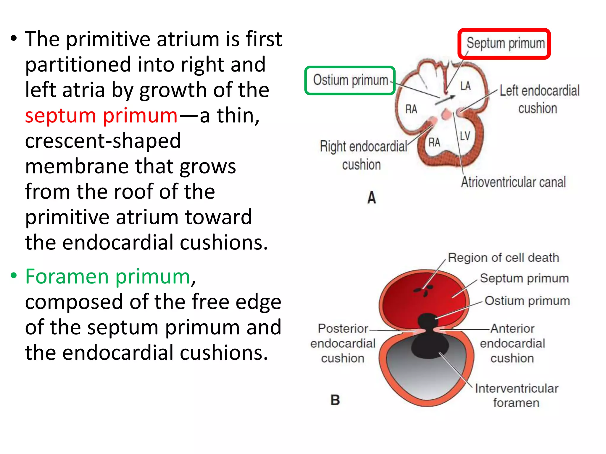 Atrial Septal Defect | PPTX