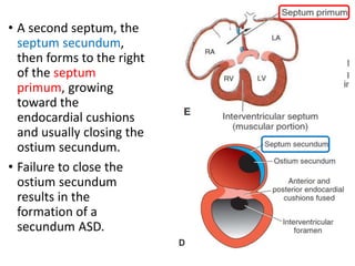 Atrial Septal Defect | PPT