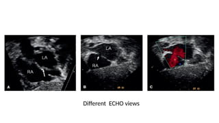 Atrial Septal Defect and its overview_SAJAL.pptx