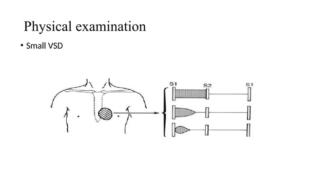 Congenital heart disease - ASD and VSD . | PPTX | Heart and ...