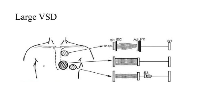 Congenital heart disease - ASD and VSD . | PPTX | Heart and ...