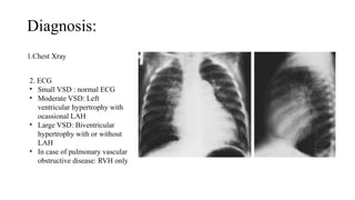 Congenital heart disease - ASD and VSD . | PPTX