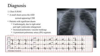 Congenital heart disease - ASD and VSD . | PPTX