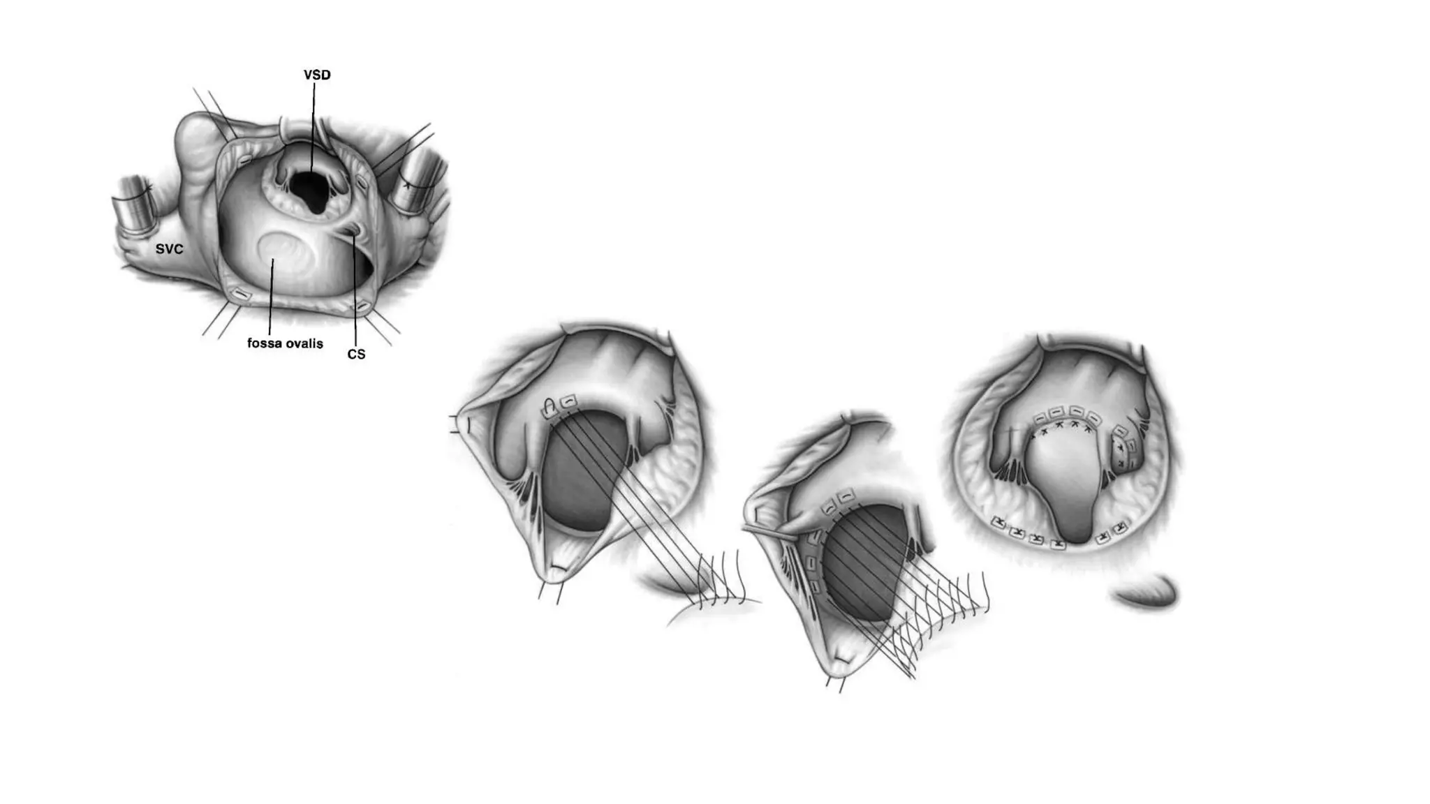 Atrial Septal Defects, Ventricular septal defects Assessment ...