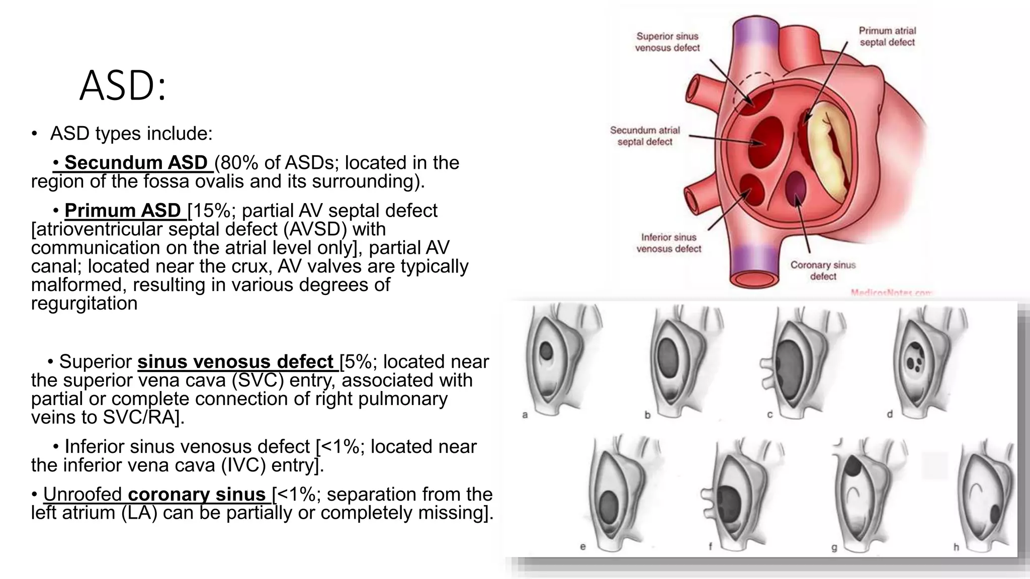 Atrial Septal Defects, Ventricular septal defects Assessment,Investigations and managemnet ASD ...