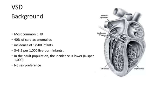 Atrial Septal Defects, Ventricular septal defects Assessment,Investigations and managemnet ASD ...