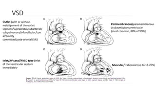 Atrial Septal Defects, Ventricular septal defects Assessment ...