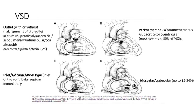 Atrial Septal Defects, Ventricular septal defects Assessment,Investigations and managemnet ASD ...