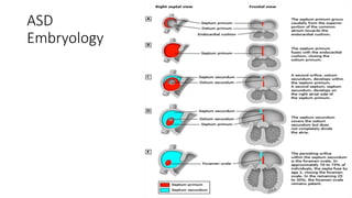 Atrial Septal Defects, Ventricular septal defects Assessment ...
