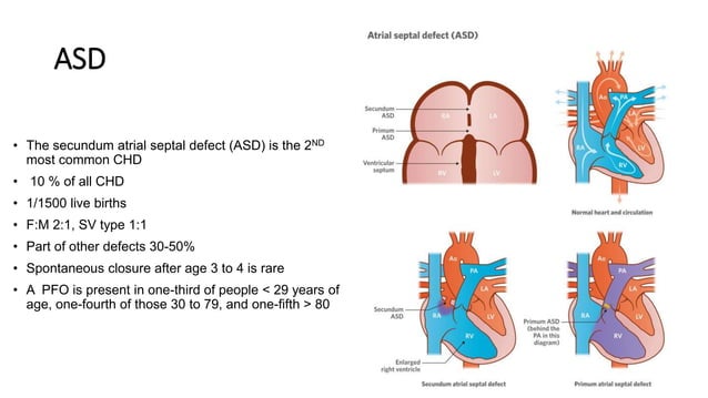 Atrial Septal Defects, Ventricular septal defects Assessment,Investigations and managemnet ASD ...