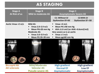 Echocardiographic evaluation of Aortic stenosis | PPTX