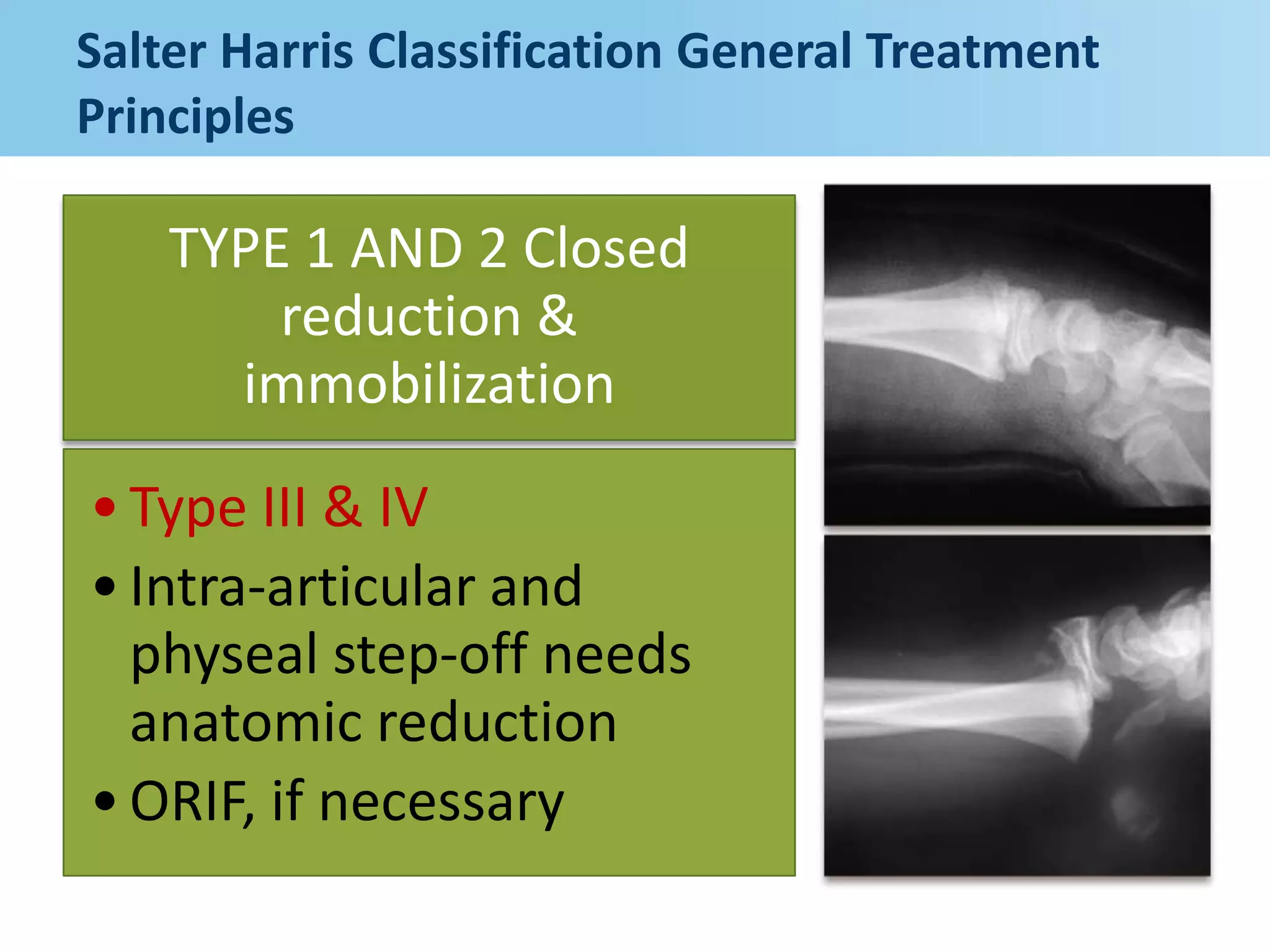 orthopaedic fractures in children | PPTX