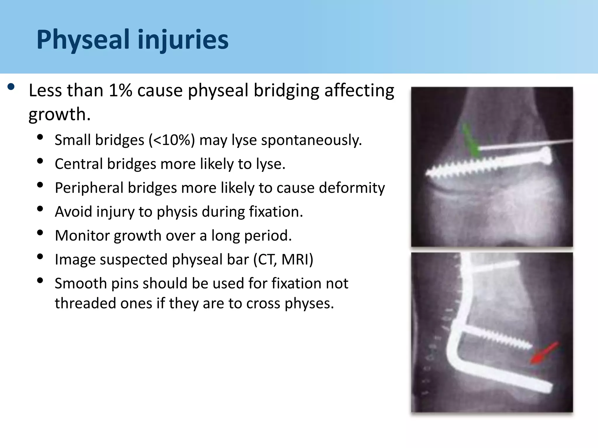 orthopaedic fractures in children | PPTX