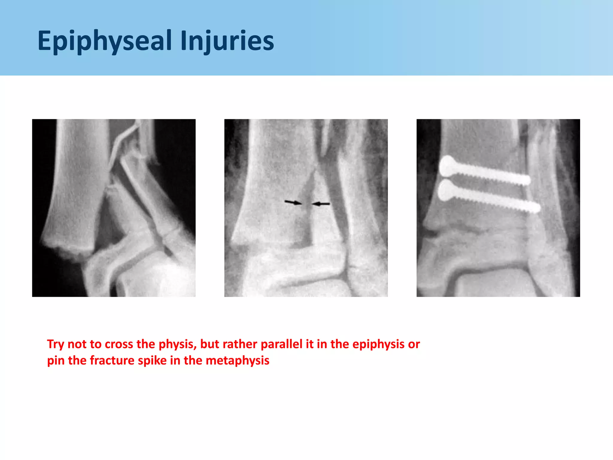 orthopaedic fractures in children | PPTX